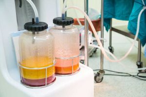 Liposukcija: vrste, cena, rizici i iskustva | Minut za mene